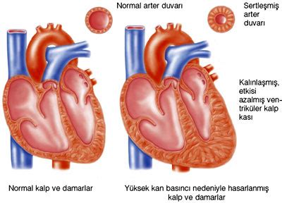 Kalp Yetersizli Ine Yol A An Nedir Sa L K Park