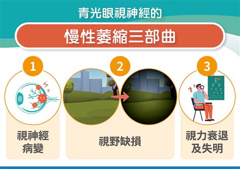 視力正常不必擔心青光眼七大篩檢項目 歲起不可少 今健康