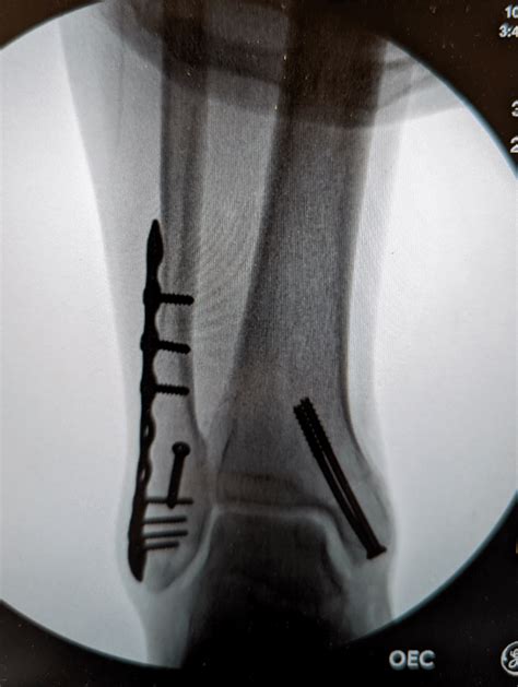New Hardware After Orif And Ocd Repair R Xrayporn