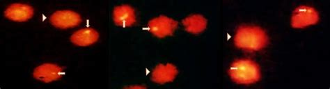 Visualization Of γ H2ax Foci In Lymphocytes Patients Typical