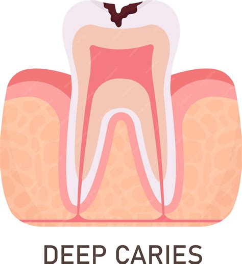 Premium Vector Deep Caries Tooth Problem