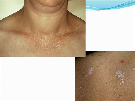 Склеродермия Sclerodermia презентация онлайн