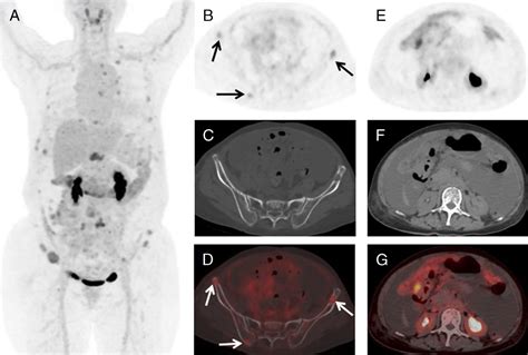 68Ga FAPI Outperforms 18F FDG PET CT In Identifying Bone Met Clinical Nuclear Medicine