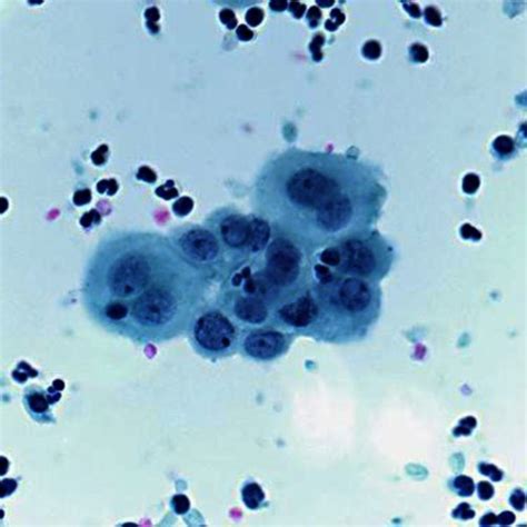 Aspiration Of Ascites Shows Atypical Mesothelial Cells Originating
