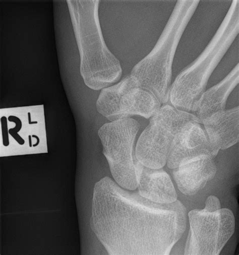 Ulnar Deviation X Ray Radiographic Imaging Of Scaphoid Frx Wheeless
