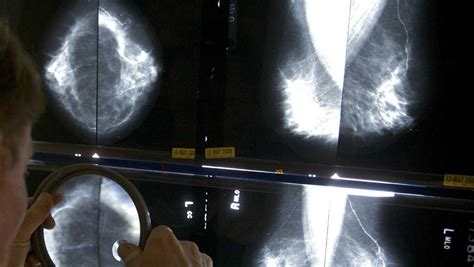 Us Requires New Info On Breast Density With All Mammograms