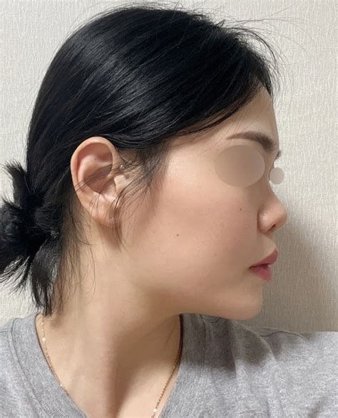 짧은코수술 후기 코가 예뻐져서 너무너무 좋습니당 ㅎㅎㅎㅎ 수술후기 나를 위해 선택한 차민성형외과