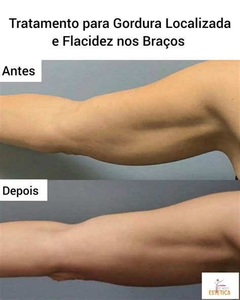 Tratamento Para Gordura Localizada E Flacidez Nos Braços