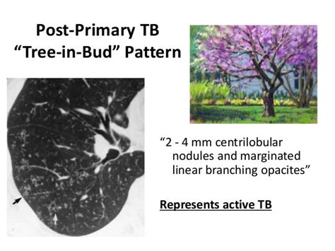 Tb Drugs And Adr