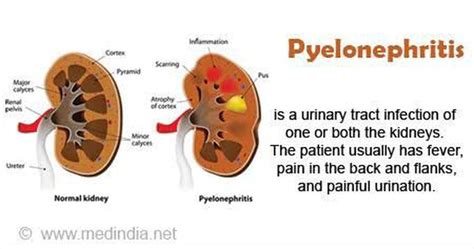 Pyelonephritis Medizzy