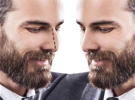 Rhinoplasty For Deviated Septum All You Need To Know