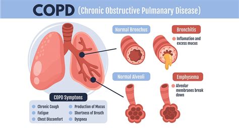 Treatment Of Copd And Advancements Wellness Home Dr Vikas Mittal
