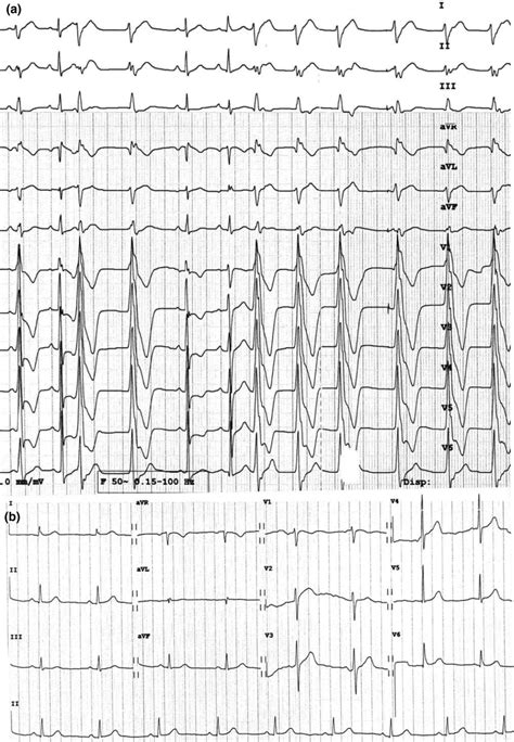 Panel A Electrocardiogram Taken 2 Days After The Ablation Procedure