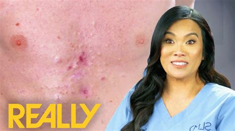 Dr Lee Pops Over 40 Pimples From Patient S Chest Dr Pimple Popper