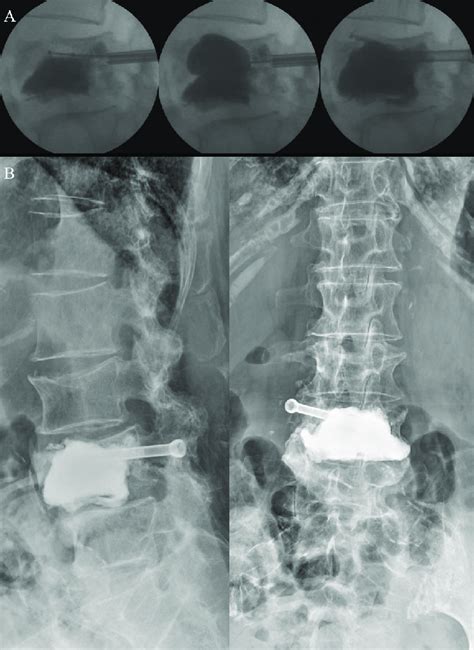 Case 2 A Intraoperative X Ray Fluoroscopic Image The Balloon Was Download Scientific