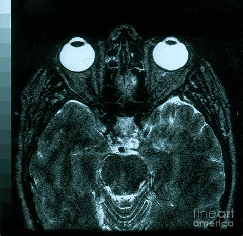 Mri Of Normal Brain Photograph By Science Source Fine Art America