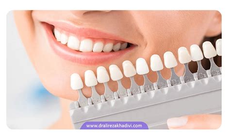 روکش دندان چیست؟ همه چیز درمورد روکش کردن دندان