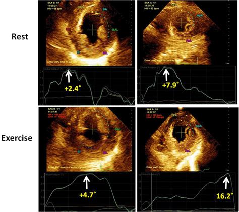 Resting On The Top And Exercise On The Bottom Basal On The Left