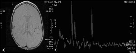 Cerebral Magnetic Resonance Image Axial T2 Fast Spin Echo Sequence Download Scientific
