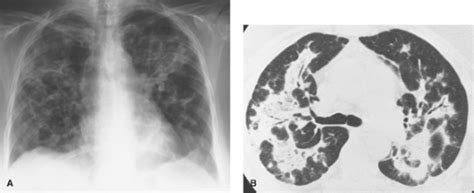 Diffuse Lung Disease Radiology Key