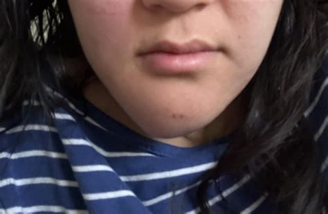 Chin Swelling After Crashing Bike Rmedical