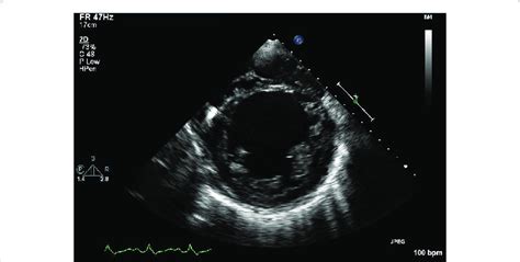 Parasternal Short Axis View At The Level Of Papillary Muscles Showing