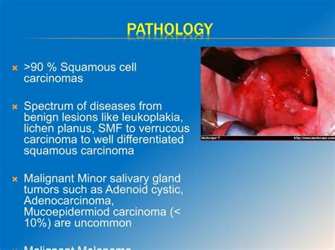 Carcinoma Buccal Mucosa Ppt