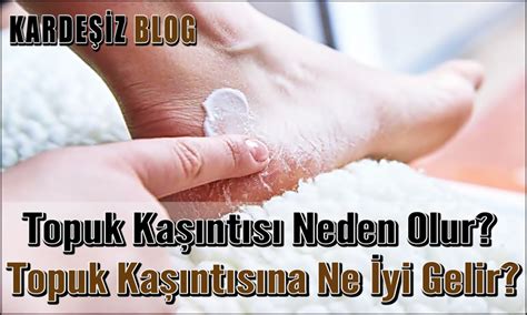 Topuk Kaşıntısı Neden Olur Topuk Kaşıntısına Ne İyi Gelir