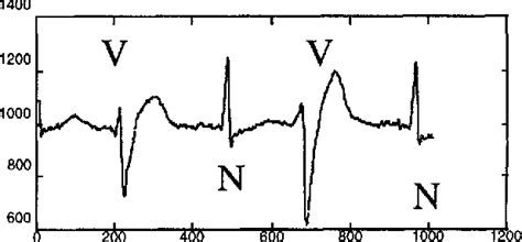 Figure 1 From Previous Identification Of Qrs Onset And Offset Is Not