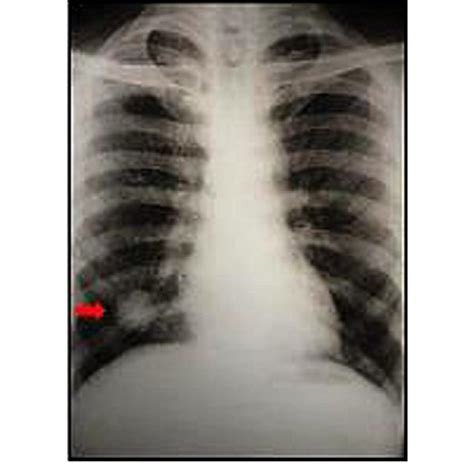 Chest X Ray Nodular Opacity Apical Region Of Right Lung Download Scientific Diagram