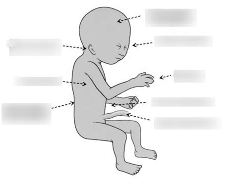 Complete Triploidy At Edna Weiss Blog