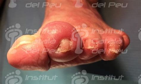 Que Es Celulitis De Pie Mundo Multimedia