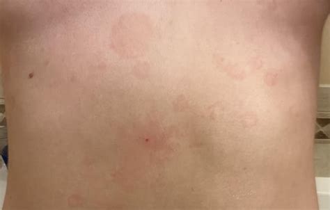 Ring Worm Or Excema Rmedicaladvice
