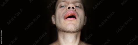 Plump Lips Allergic Reaction Of Angioedema In A Man On The Lip The