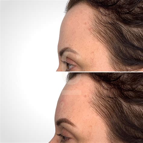 Forehead Dermal Fillers Cosmetic Connection