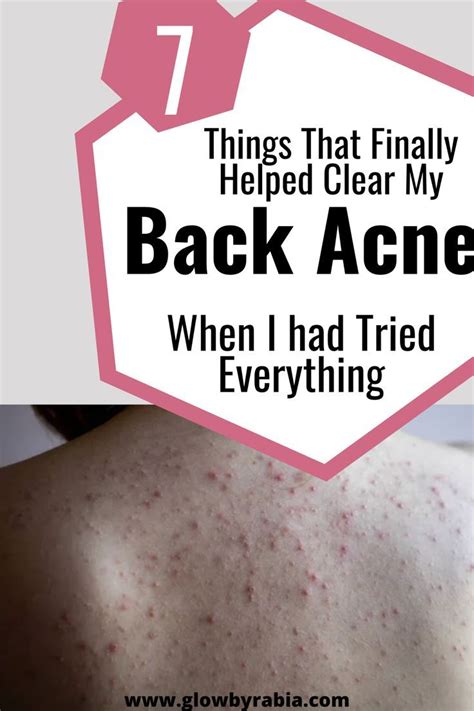 Everything You Need To Know About Treating Back Acne Artofit