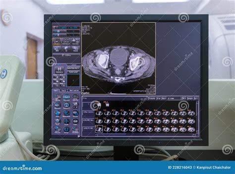 Computer Screen Showing Mri Ct Image Scan Of The Brain Ct Whole