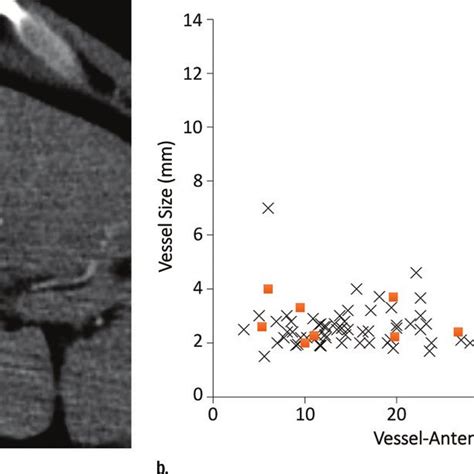 Hepatitis C Infection And Hcc In A 64 Year Old Man A Axial