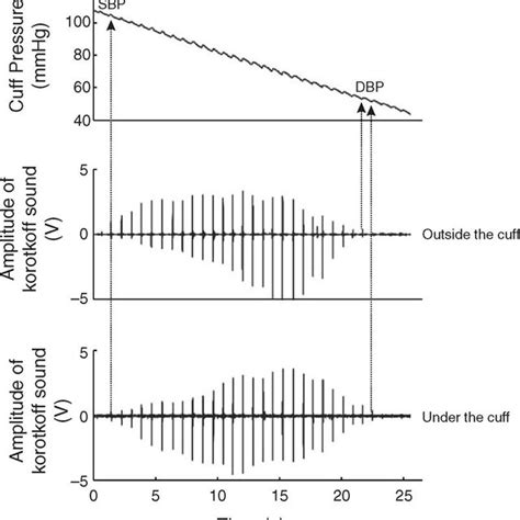 Example Of Korotkoff Sounds Recorded With The Stethoscope Outside