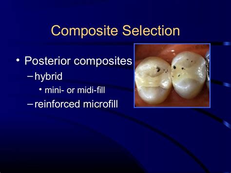 Composite And Acid Etching