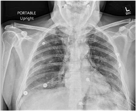 Frontal Chest Radiograph On The Morning Of Admission Day 12 The