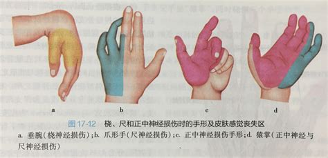 物理治疗师知晓的臂丛神经解剖及损伤表现 搜狐大视野 搜狐新闻