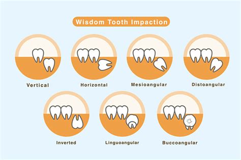 5 Things You Need To Know About Wisdom Tooth Extraction