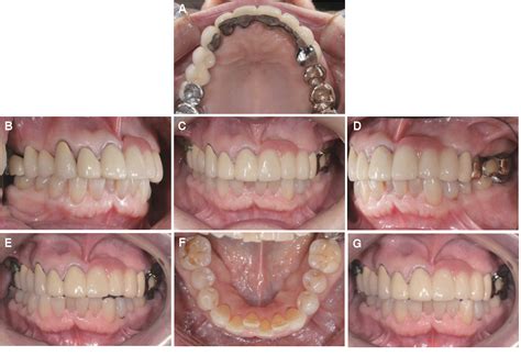 Figure 5 From Prosthetic Reconstruction Of Maxillary Defect Resulting