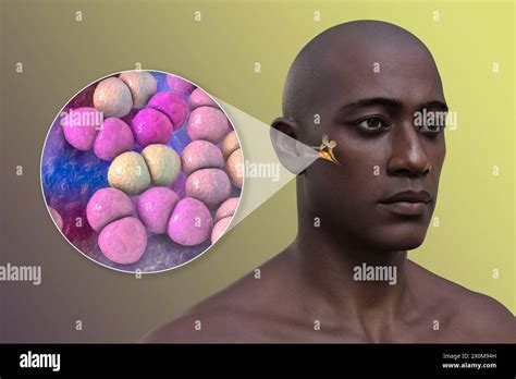 3d Illustration Of A Man With A Bacterial Infection Of The Middle Ear