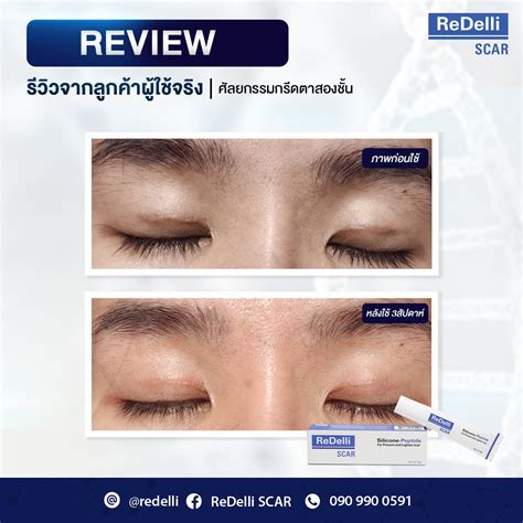 Redelli Scar Redelli Scar ดูแลปัญหาแผลเป็น Facebook