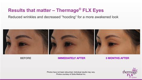 Thermage® Profile Beauty Clinic