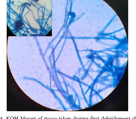 Figure 1 From Fungal Carbuncle Due To Apophysomyces Elegans—a Case