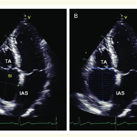 Pdf Right Atrial Size And Function Assessed With Three Dimensional And Speckle Tracking