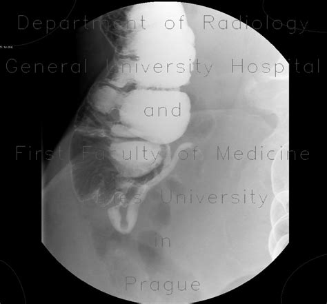 Radiology Case Appendicography Appendicolith Fecal Stone